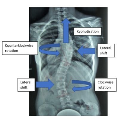S.E.A.S. (Scientific Exercise Approach to Scoliosis) Exercises