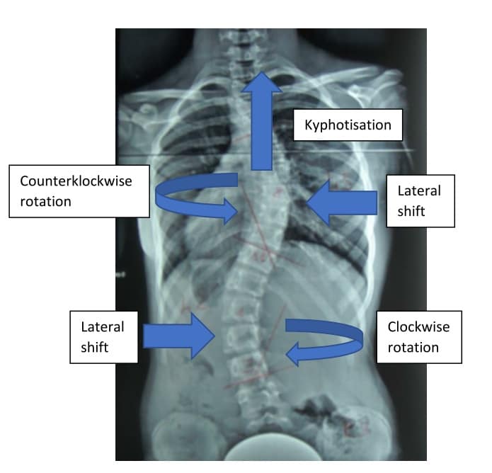S.E.A.S. (Scientific Exercise Approach to Scoliosis) Exercises