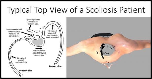 Structural Scoliosis vs Nonstructural Scoliosis
