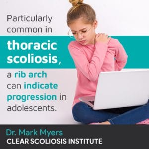 Rib Humps and Scoliosis: What Causes It & How To Treat It