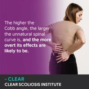 How to Measure Scoliosis Curvature: The Cobb Angle Method